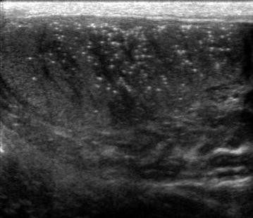Incidental Scrotal Findings at Imaging-1: Calcifications | SpringerLink