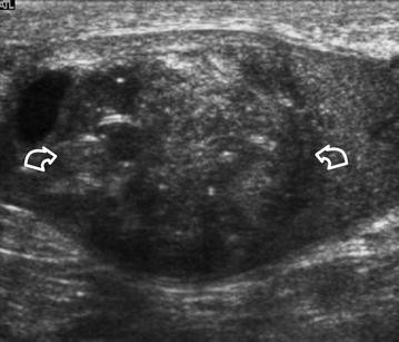 Incidental Scrotal Findings at Imaging-1: Calcifications | SpringerLink