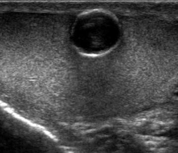 Incidental Scrotal Findings at Imaging-1: Calcifications | SpringerLink