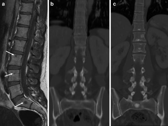MRI of Bone Metastases | SpringerLink