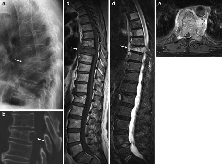 MRI of Bone Metastases | SpringerLink