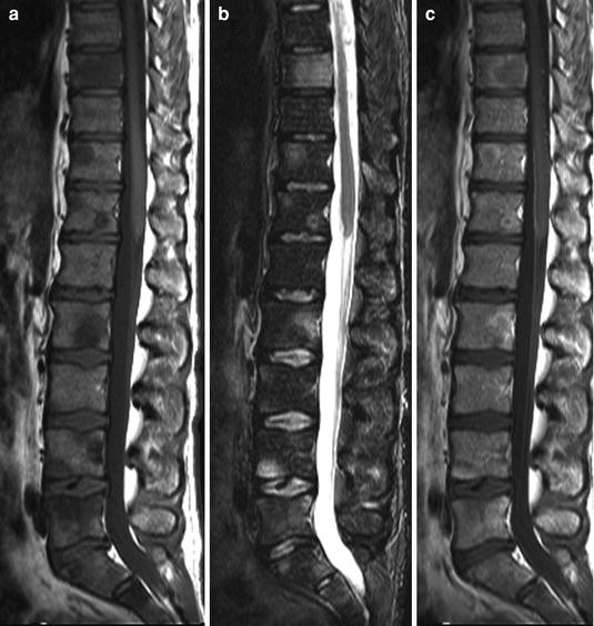 MRI of Bone Metastases | SpringerLink