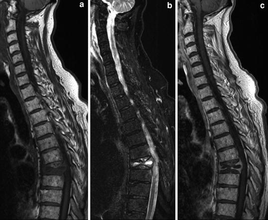 MRI of Bone Metastases | SpringerLink