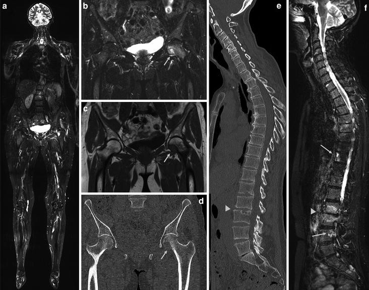 MRI of Bone Metastases | SpringerLink