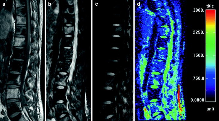 MRI of Bone Metastases | SpringerLink