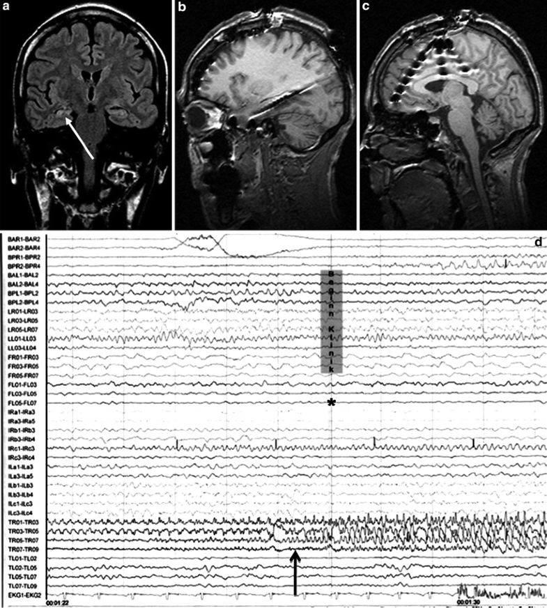 The Term “Epileptogenic Lesion” and How to Use it | SpringerLink