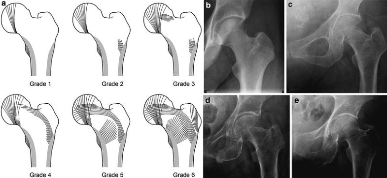 Radiography in Osteoporosis | SpringerLink