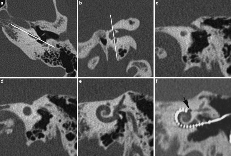 MultiPlanar Reformation in CT of the Temporal Bone | SpringerLink