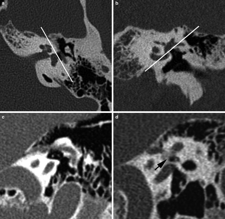 MultiPlanar Reformation in CT of the Temporal Bone | SpringerLink