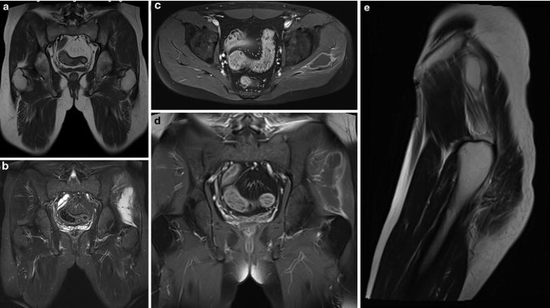 MRI in Inflammatory Myopathies and Autoimmune-Mediated Myositis ...