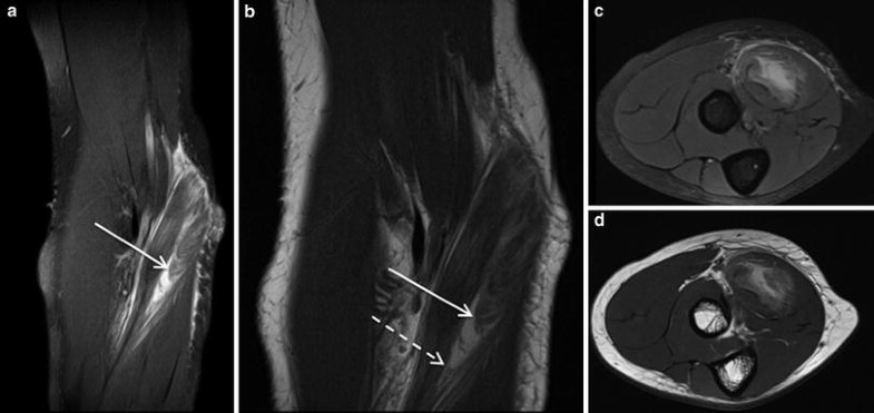 MRI of Muscle Injuries | SpringerLink
