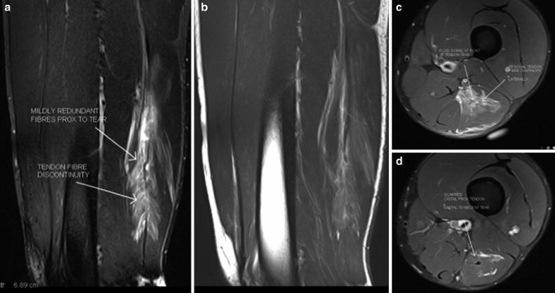 MRI of Muscle Injuries | SpringerLink