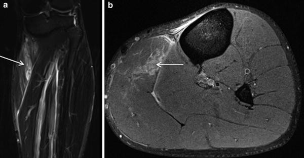 MRI of Muscle Injuries | SpringerLink