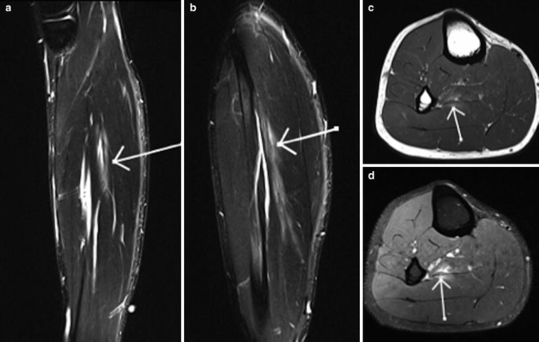 MRI of Muscle Injuries | SpringerLink