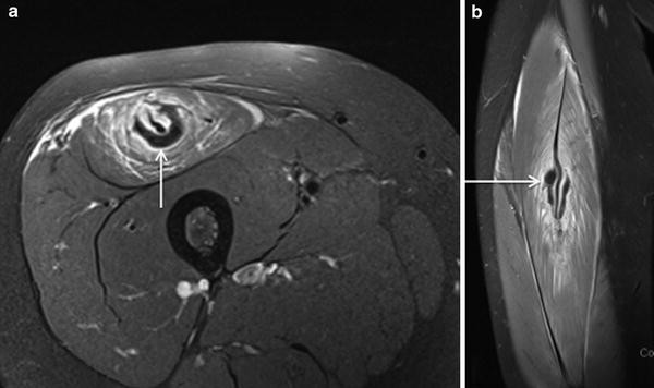 MRI of Muscle Injuries | SpringerLink