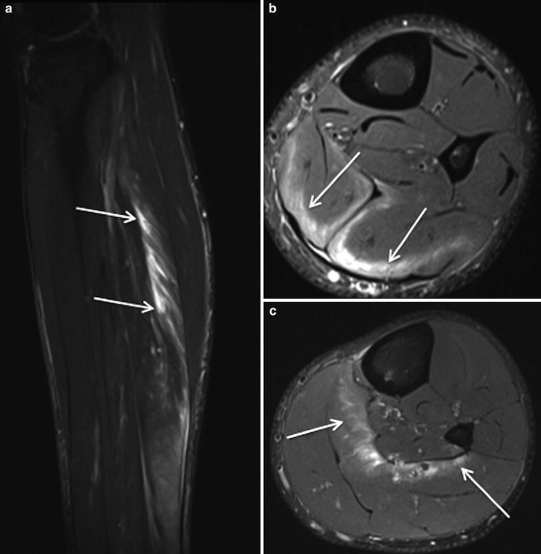 MRI of Muscle Injuries | SpringerLink