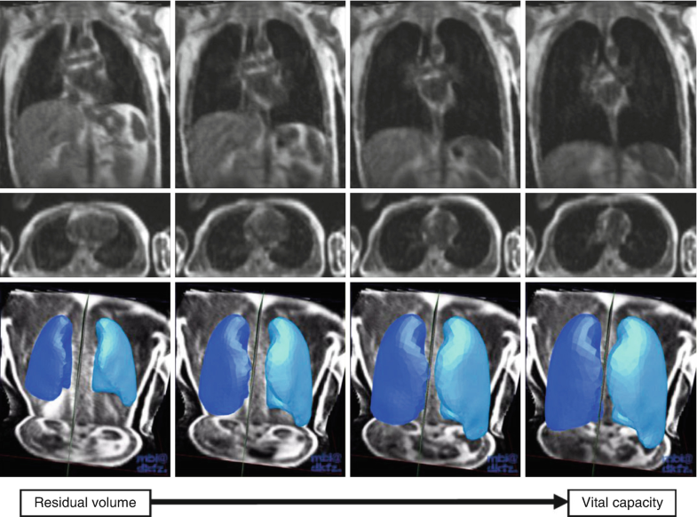 Dynamic MRI of Respiratory Mechanics and Pulmonary Motion | SpringerLink