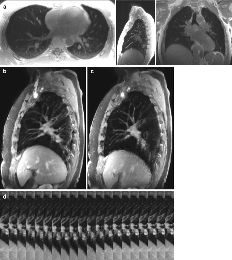 Dynamic MRI of Respiratory Mechanics and Pulmonary Motion | SpringerLink