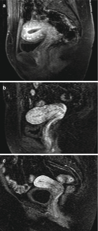 Uterus: Normal Findings | SpringerLink