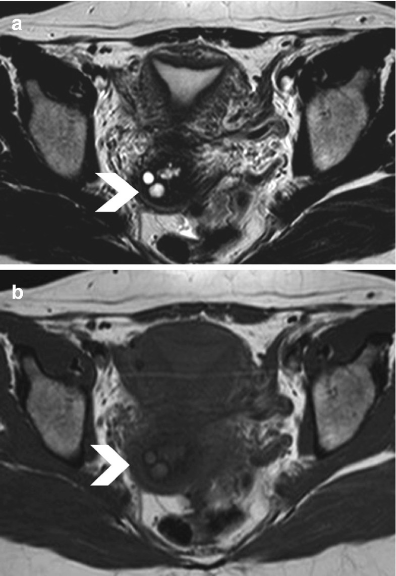 Uterus: Normal Findings | SpringerLink