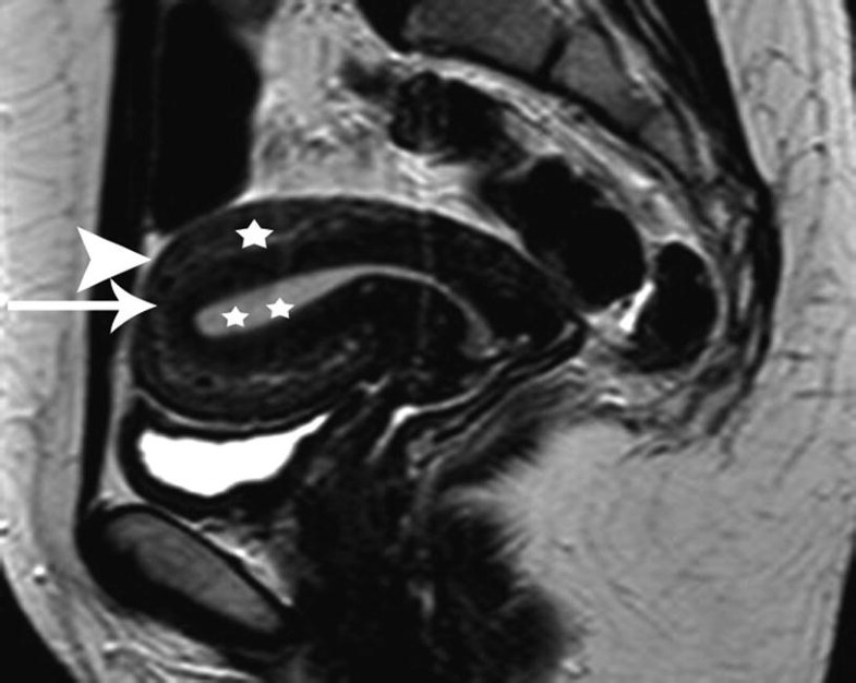 Uterus: Normal Findings | SpringerLink
