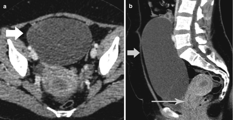 Uterus: Normal Findings | SpringerLink