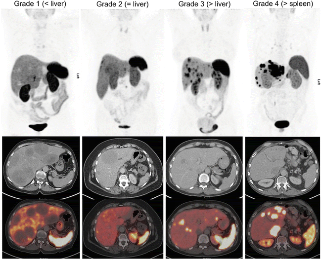 Multislice PET/CT in Neuroendocrine Tumors | SpringerLink