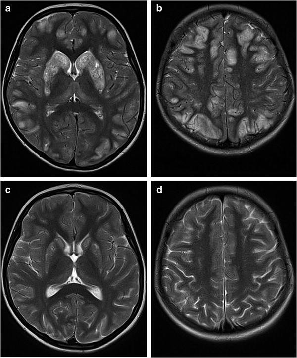 Biotin-Responsive Basal Ganglia Disease: A Treatable Differential ...