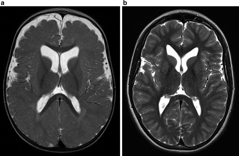 Fumarase Deficiency: A Safe and Potentially Disease Modifying Effect of ...