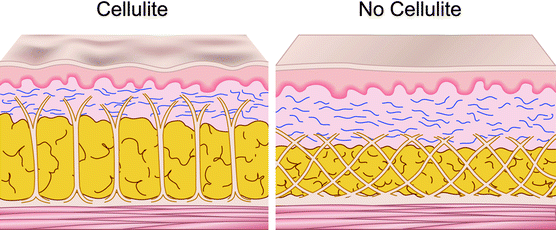 Cellulite | SpringerLink