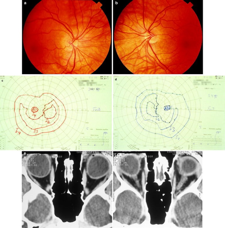 Congenital Optic Disc Anomalies | SpringerLink