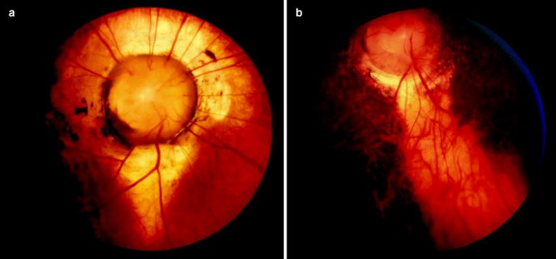 Congenital Optic Disc Anomalies | SpringerLink