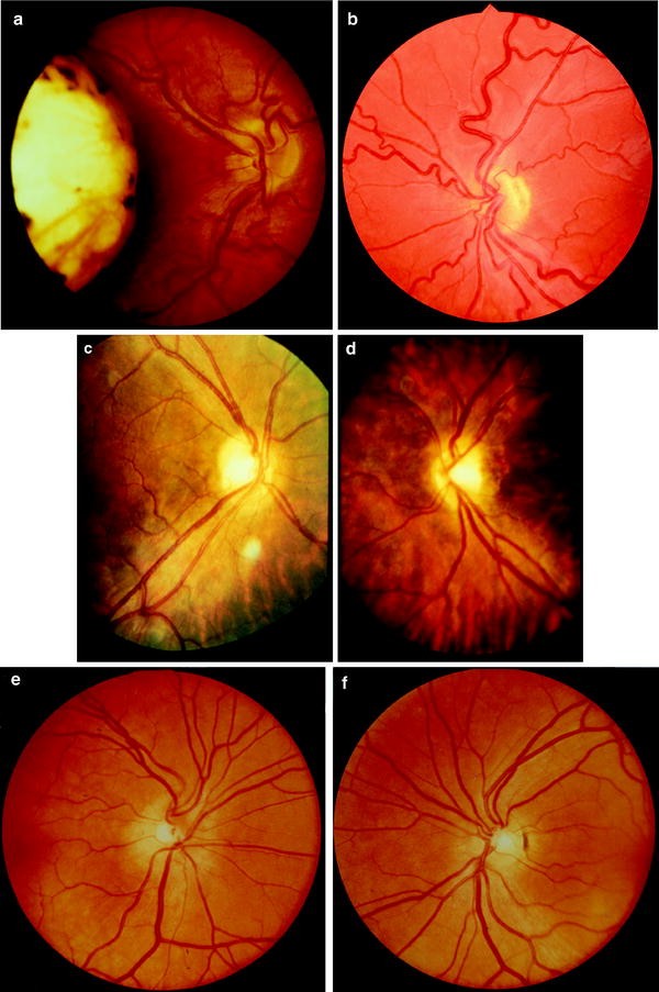 Congenital Optic Disc Anomalies | SpringerLink