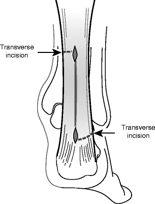 Percutaneous Z Tendon Achilles Lengthening | SpringerLink