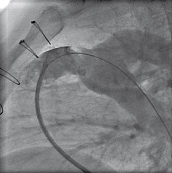 RV-PA Conduit Dilation and Stenting | SpringerLink