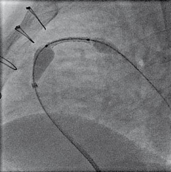 RV-PA Conduit Dilation and Stenting | SpringerLink