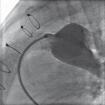 RV-PA Conduit Dilation and Stenting | SpringerLink