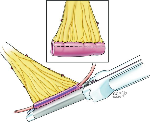 Antegrade Colonic Enema (ACE) | SpringerLink