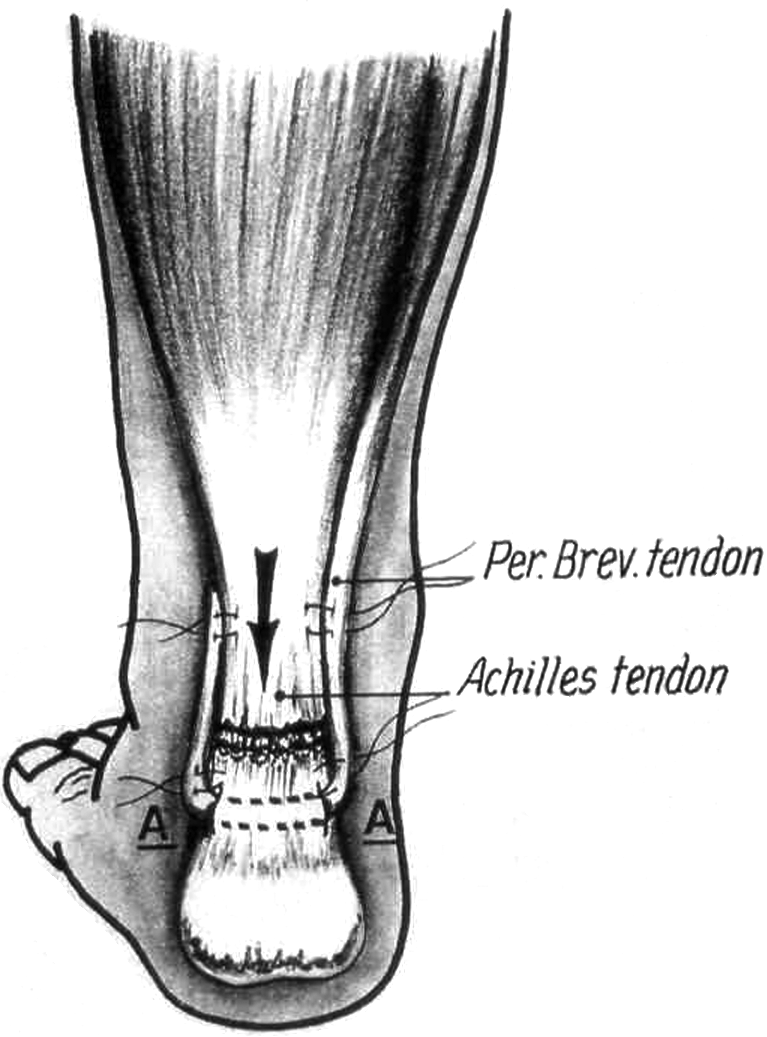 Treatment of Chronic Achilles Tendon Ruptures with Tendon Transfers ...