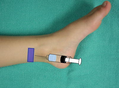 Ankle Blocks | SpringerLink