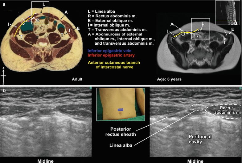 Rectus Sheath and Transversus Abdominis Plane (TAP) Blocks | SpringerLink