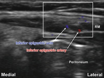 Rectus Sheath and Transversus Abdominis Plane (TAP) Blocks | SpringerLink