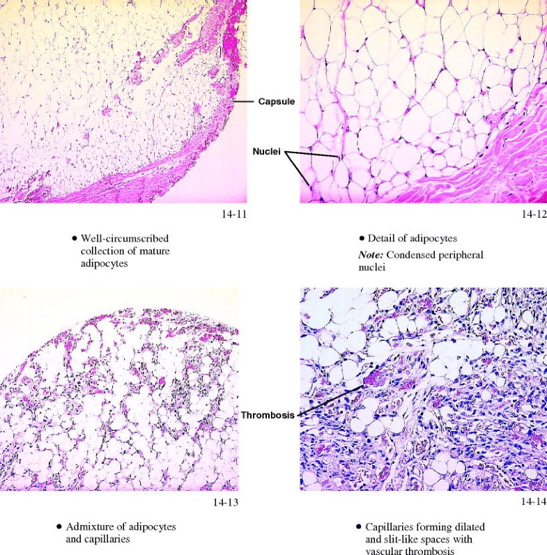 Benign Mesenchymal Tumors | SpringerLink