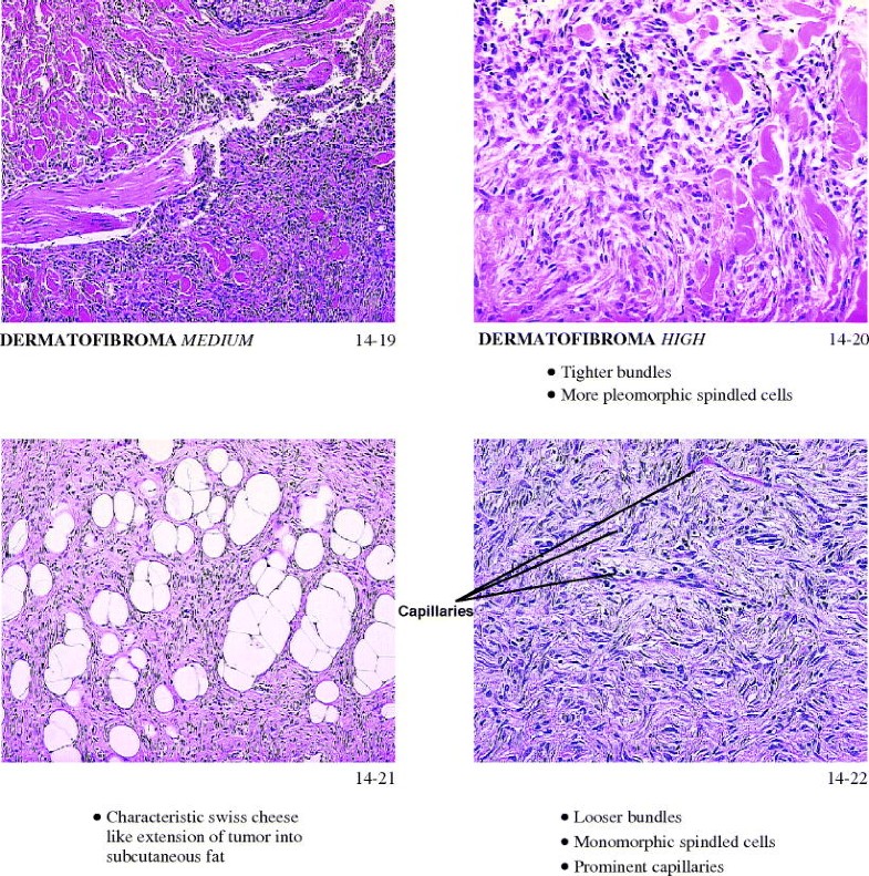Benign Mesenchymal Tumors | SpringerLink