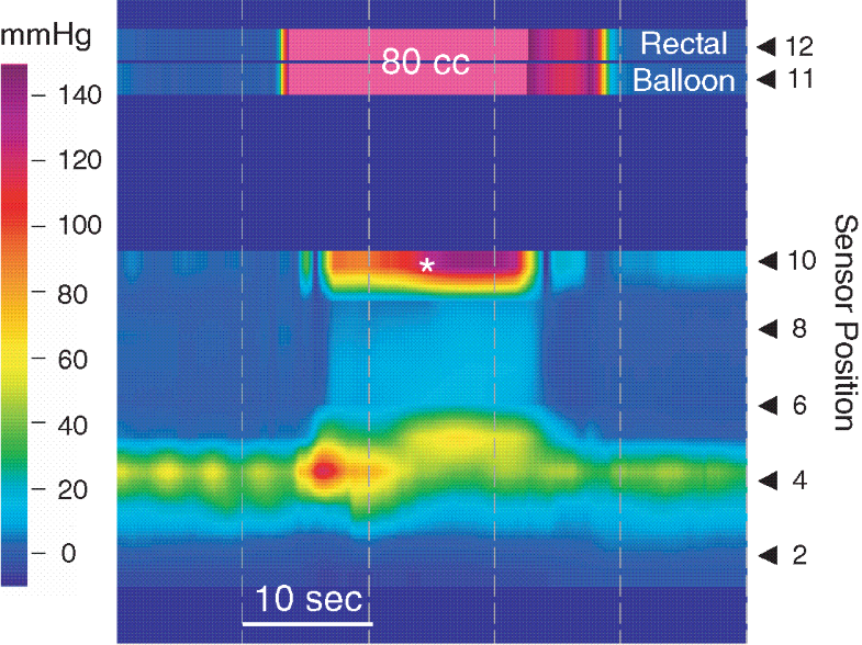 Anorectal Manometry | SpringerLink