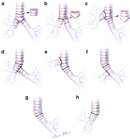 Tracheal Resection and Reconstruction | SpringerLink