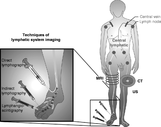 Radionuclide Lymphoscintigraphy | SpringerLink