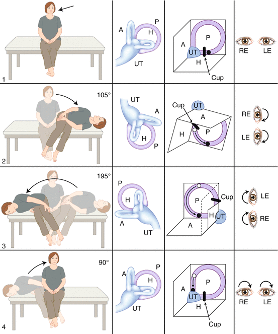 Peripheral Vestibular Forms of Vertigo | SpringerLink