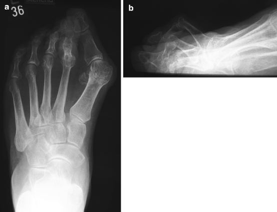 Surgical Treatment of Hammer Toe, Claw Toe, and Mallet Toe Deformity ...