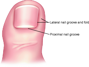 Current Techniques of Toenail Surgery | SpringerLink